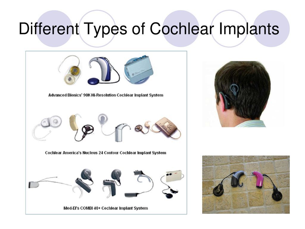 cochlear implant device types